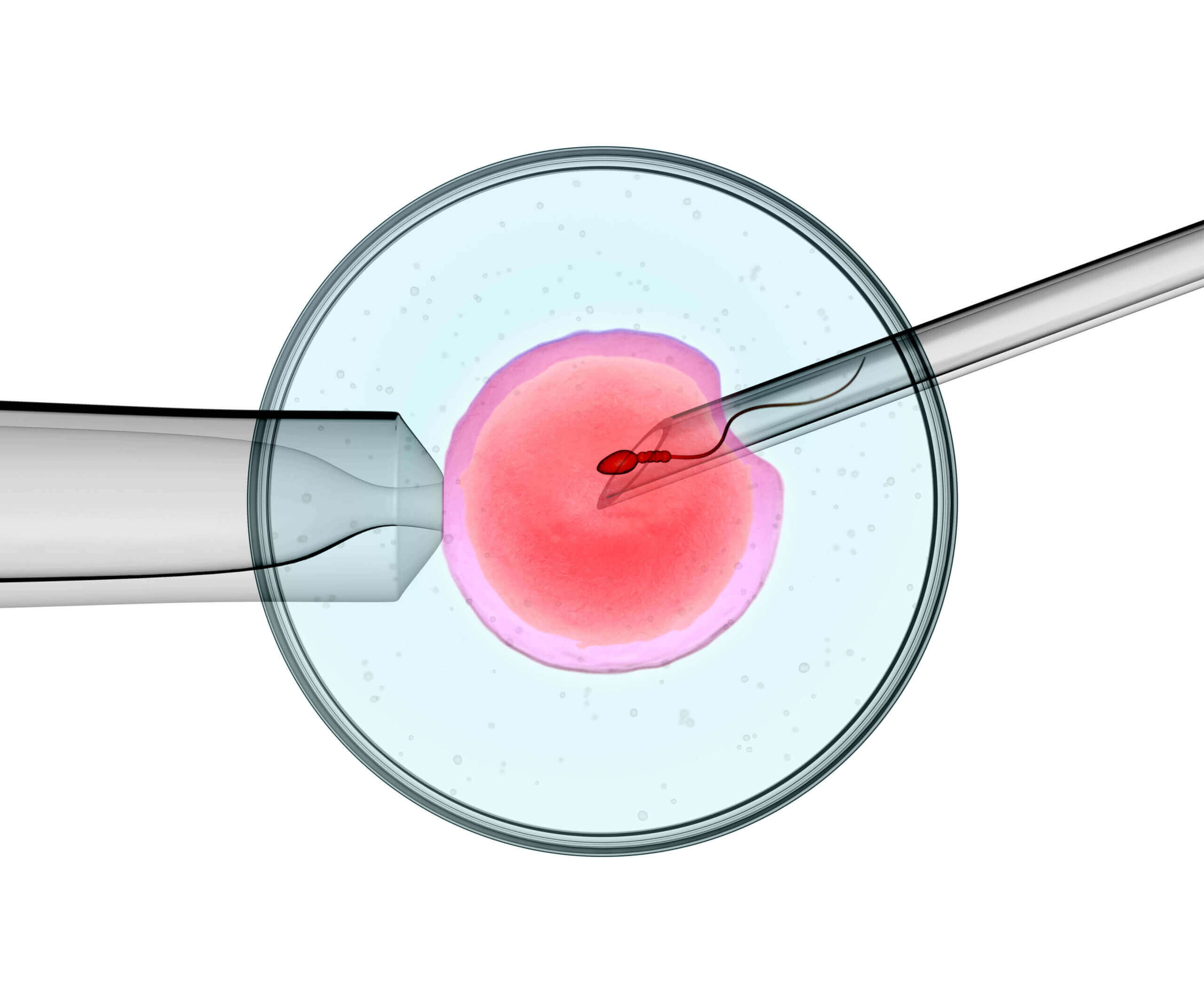 What is Intracytoplasmic Sperm Injection (ICSI)? - Inovi Fertility ...