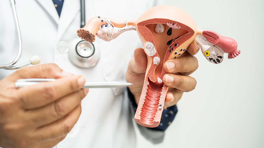 Polypectomy and Conception Rates: Polyp Characteristics